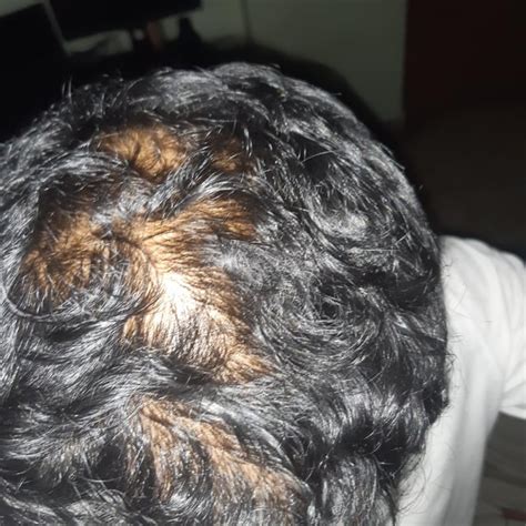 12 Month Vs 9 Month Finasteride Comparison Rtressless