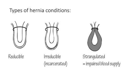 Types Of Hernia Pptx