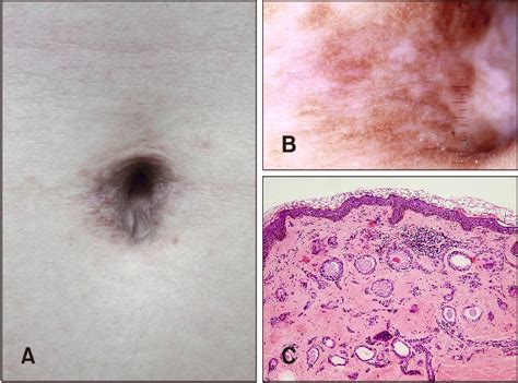 A Multiple Small Slightly Raised Brown Colored Papules Located In Download Scientific