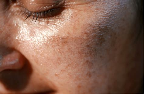 Environmental Factors In Skin Health Us Dermatology Partners