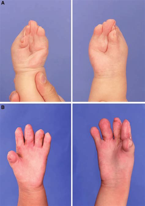 A Preoperative Photographs Of A 1 Year Old Apert Patient With Upton