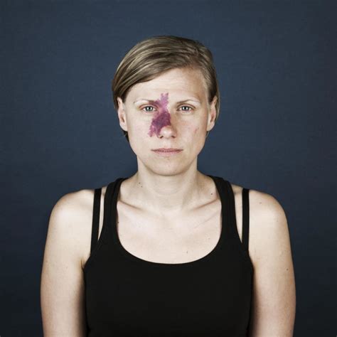 19 Stunning Portraits Of People With Birthmarks Bored Panda