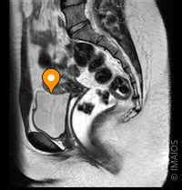 Vesicouterine Pouch E Anatomy Imaios