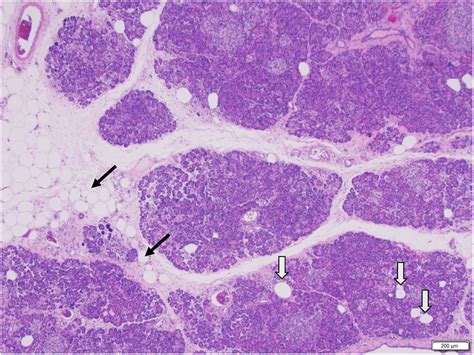 The Fatty Pancreas Current Evidence Treatment Implications And