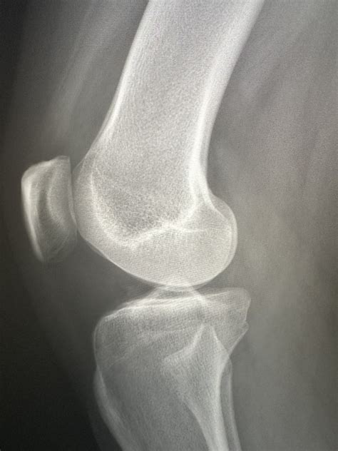 Lateral Knee Xray Rotation