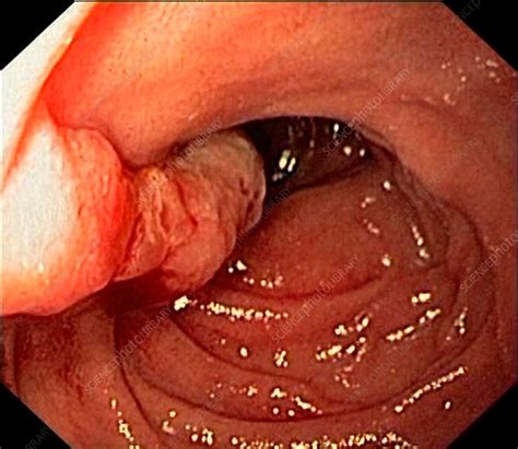 Familial Adenomatous Polyposis Duodenum Endoscope View Stock Image