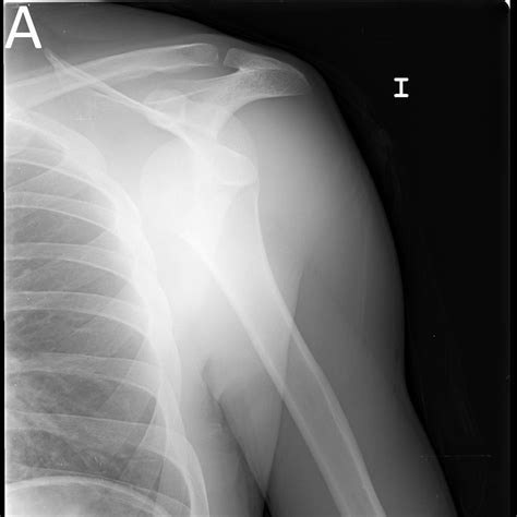 Coracoid Processes Fracture Associated With Anterior Shoulder Dislocation Eurorad