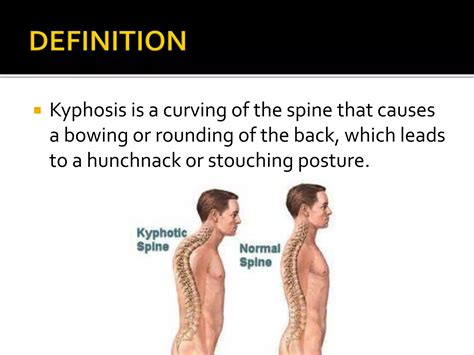Kyphosis Lordosis Pptx