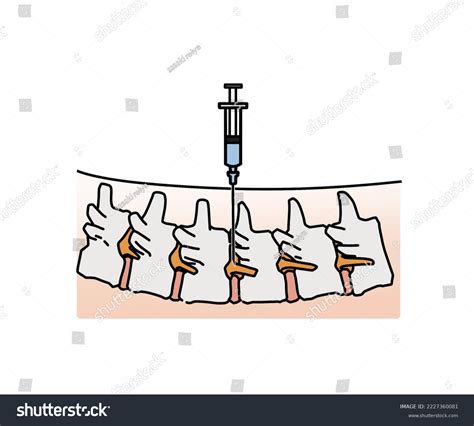 Nerve Root Blockmedical Drawing Materials Stock Illustration 2227360081