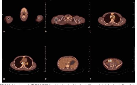 A Case Report Systemic Lymph Node Tuberculosis Mimicking Lymphoma On 18