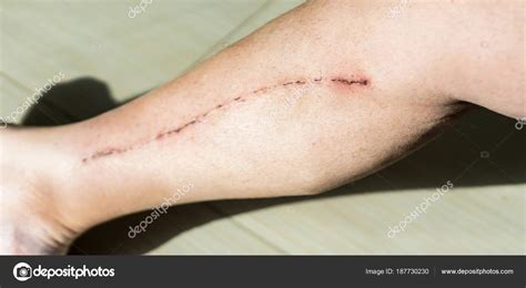 Selective Focus Of Male Human Leg With Scar From Cardiac Surgery Of