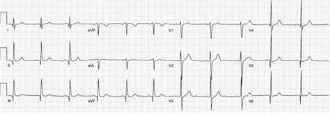 Topic Other Causes Of Q Waves 12 Lead Ecg Certification Course Acls Certification Association