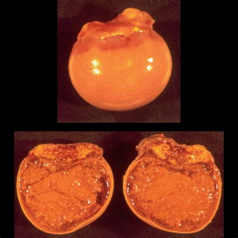 Infant With An Incidental Calcification Noted On An Axr Pediatric