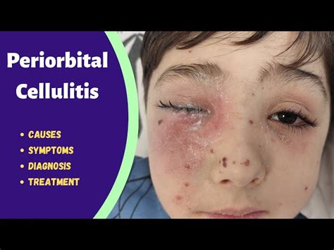 Cellulitis Face