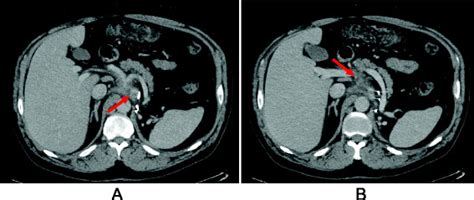Baseline Ct Scan Baseline Ct Scan Showing The Two Selected Target