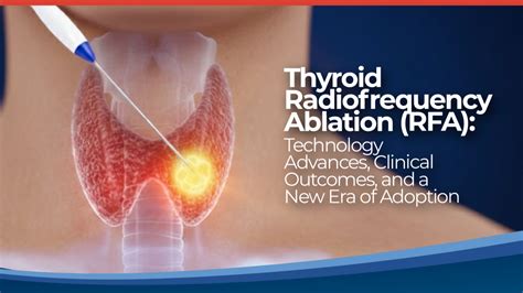 Thyroid Radiofrequency Ablation Rfa Technology Advances Clinical