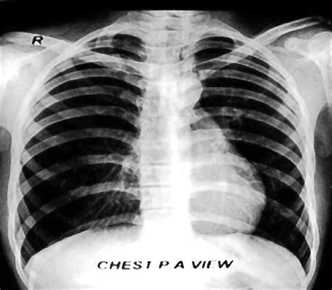Chest X Ray Showing Mediastinal Shift To Left Crowded Vascular Download Scientific Diagram