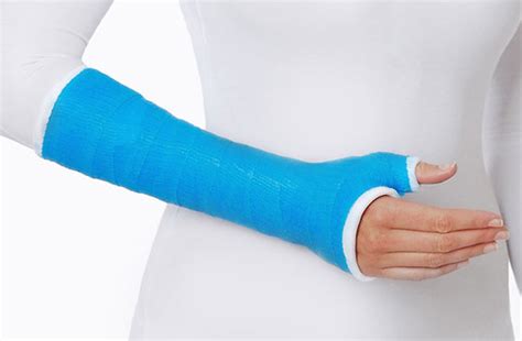 Scaphoid Bone Cast