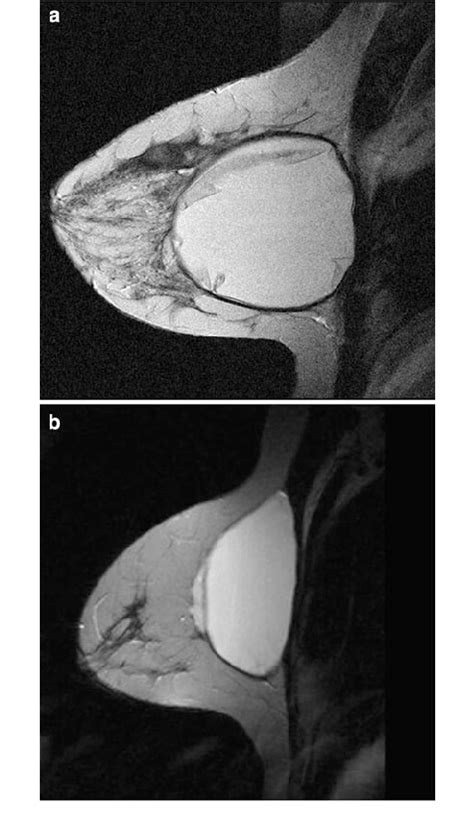 A Magnetic Resonance Image Mri Of Intracapsular Rupture Linguine