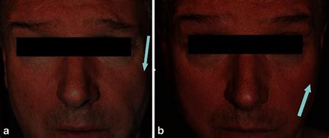 A Voluntary Subject 4 Weeks After Injection Of Three Botox Units In