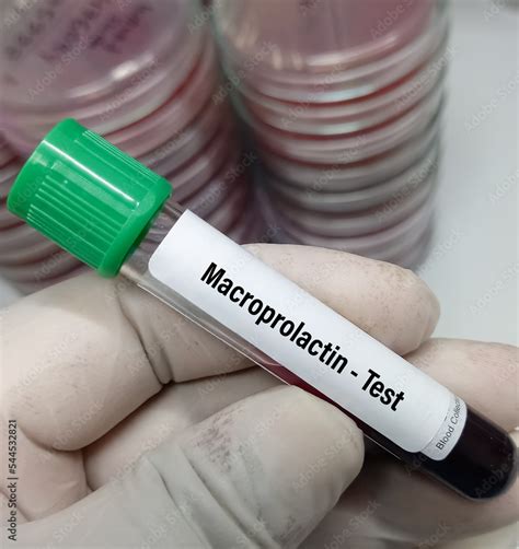 Blood Sample For Macroprolactin Test Macroprolactin Screening Test