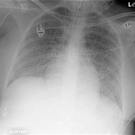 There Are Diffuse Bilateral Fine Nodular Opacities With Densely Download Scientific Diagram