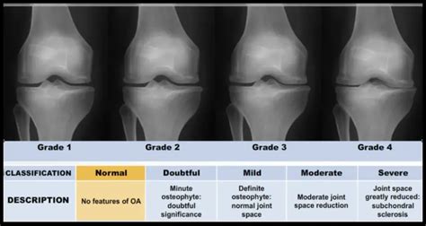 Normal Knee Joint X Ray Results What You Should Know