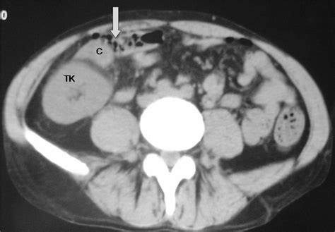Cecal Perforation Pacs