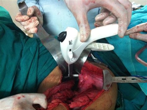 Dr Rahul Naiks Blog On Gastroenterology Gi Laparoscopic And Bariatric Surgery Total