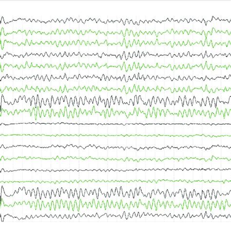 Typical Eeg Of A Patient With Anti Lgi1 Encephalitis The Inter Ictal