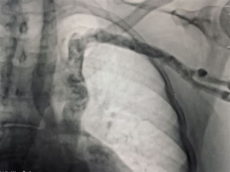 Lsvc Pacemaker Cardiology Mohammed Arshad Tk Rcis
