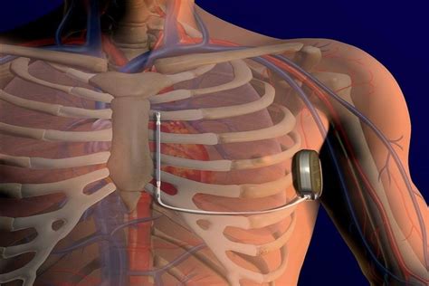 Defibrillator Vest Vs Pacemaker At James Kettler Blog