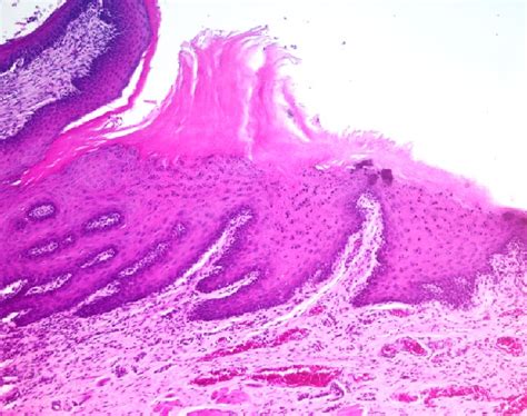 Hyperplasia And Severe Hyperkeratosis Of The Gingival Epithelium The