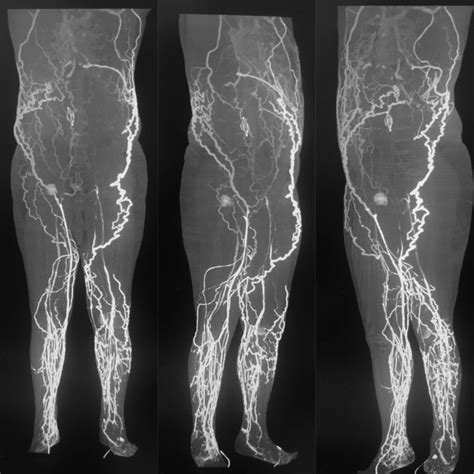 Mo Nabih On Linkedin Anjio Venography Lower Limb 100cm Contrast 2 5