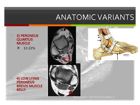 Peroneus Quartus Mri