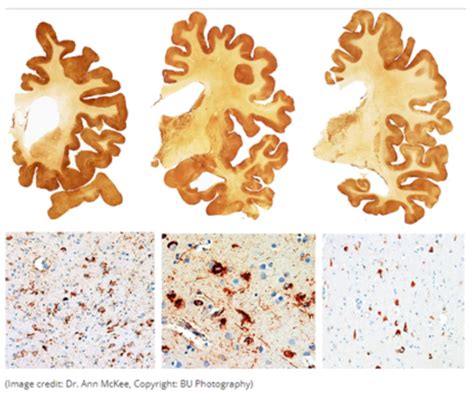 Nfl Football And Chronic Traumatic Encephalopathy Cte An Overview