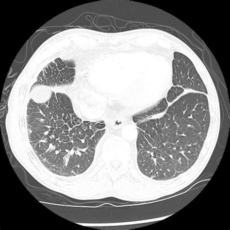 Interlobular Septal Thickening Pacs