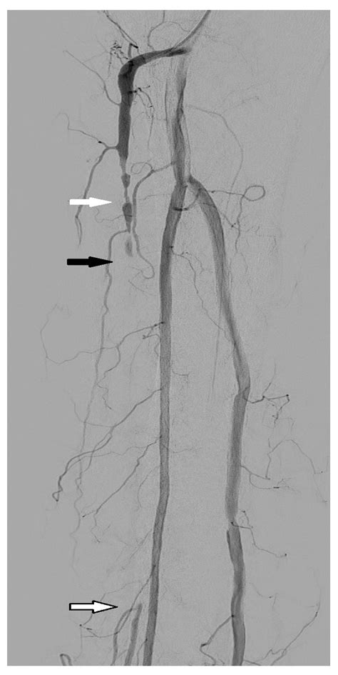 Digital Subtraction Angiography Dsa Technical And Diagnostic Aspects