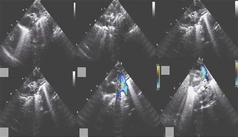 Transthoracic Echocardiography Images After Percutaneous Closure With Download Scientific