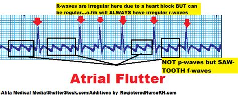 What Is The Difference Between Atrial Fibrillation A Fib Atrial Flutter A Flutter
