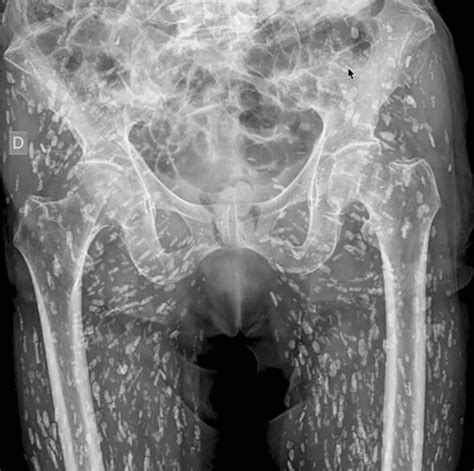 Tapeworm Infection Warning Common Kitchen Error Alert Science News