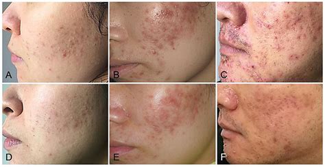 Frontiers Efficacy Of A New Non Drug Acne Therapy Aloe Vera Gel