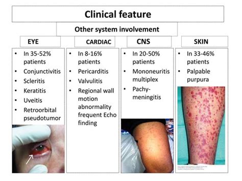 Pulmonary Vasculitiswegners Granulomatosis Pptx
