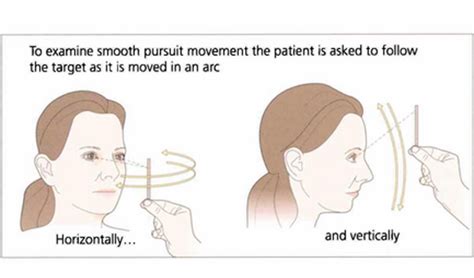 Eye Movements In Ocular Motor Dysfunction