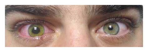 Patients Photo Showing Irregular And Dilated Pupil Of The Treated