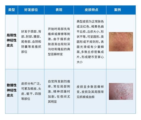 冬季来临，神经性皮炎如何养护才好？ 知乎