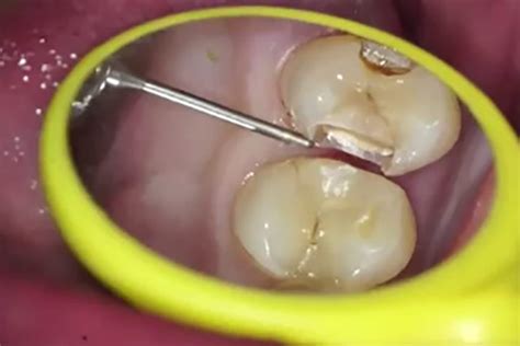 Gingiburs Burs For Gingivectomia