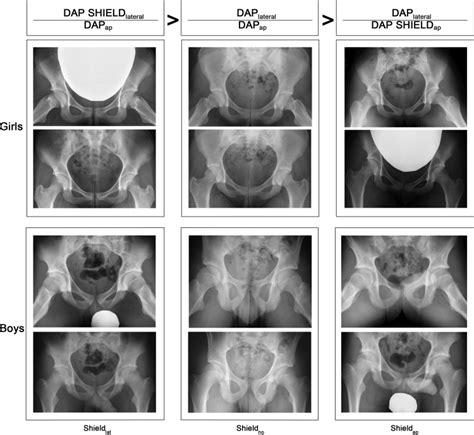 Quantification Of Increased Patient Radiation Dose When Gonadal