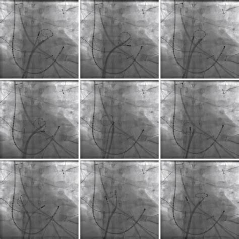 Pulmonary Vein Isolation For Atrial Fibrillation Thoracic Key