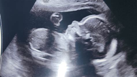 Nasal Bone Ultrasound Fetal Ultrasound Ultrasonography Ultrason